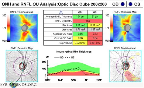 Optic Disc Visual Field Defect At Scott Sommer Blog