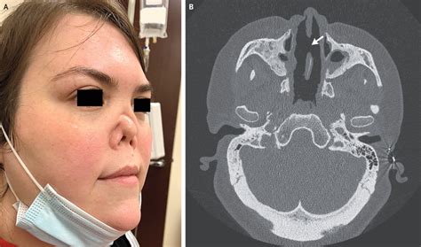 Granulomatosis With Polyangiitis Associated With Sunken Nose