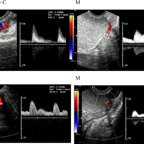 Waveforms Of The Testicular Artery Recorded By Pw Triplex Mode In A