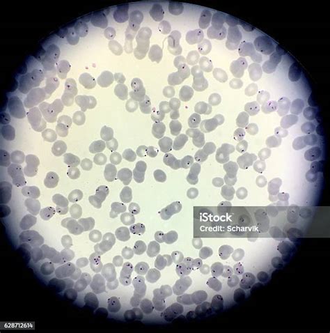 Malaria 말라리아기생충에 대한 스톡 사진 및 기타 이미지 말라리아기생충 말라리아 현미경 Istock