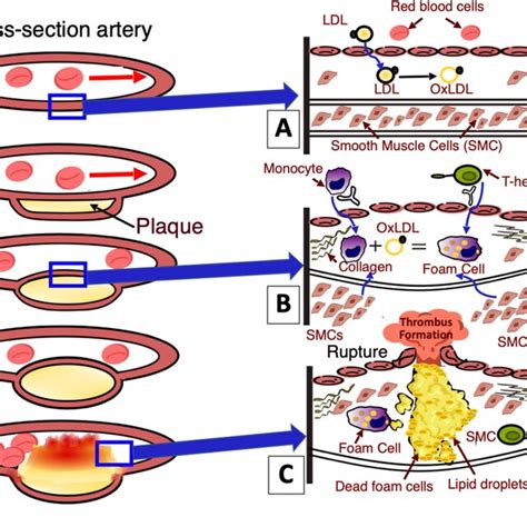 Schematic Of Atherosclerotic Plaque Progression In Arteries A