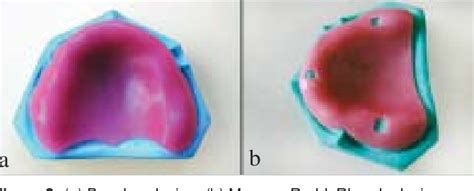 Figure 2 From The Selective Pressure Maxillary Impression A Review Of