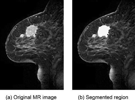 An Example Of Manually Segmented Tumor Region Download Scientific