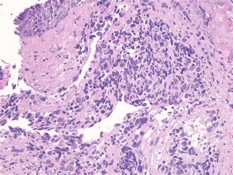 High Power Field × 200 Hematoxylin And Eosin Stain Shows Poorly