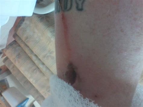 One Times I Got Sepsis And Cellulitis Ropiates