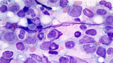 Myelodysplastic Syndrome Mds Types Symptoms And Diagnosis