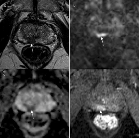 A 63 Year Old Man With Prostate Specific Antigen Level 817 Ngml The