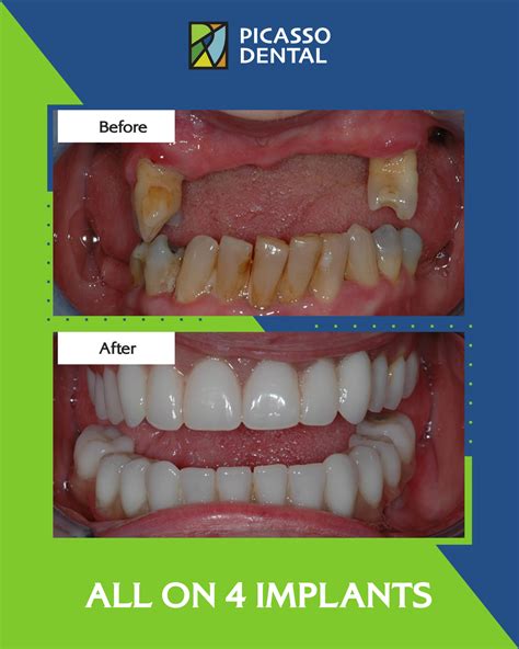 Smile Gallery Picasso Dental Clinic Vietnam