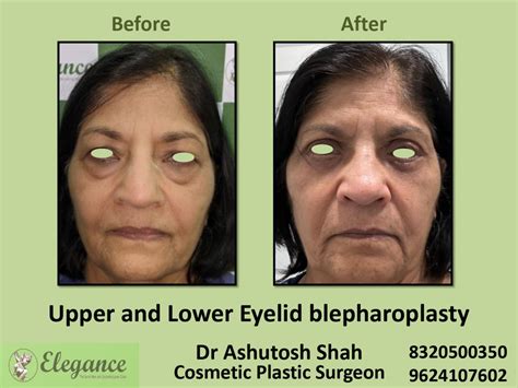 Upper And Lower Eyelid Blepharoplasty