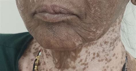 Cutaneous Clues In Secondary Adrenal Insufficiency Associated With Mixed Connective Tissue