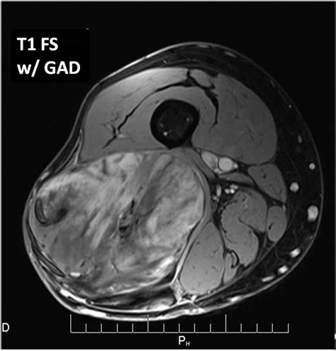 Liposarcoma Myxoid Liposarcoma Soft Tissue Sarcoma Sarcoma Surgeon