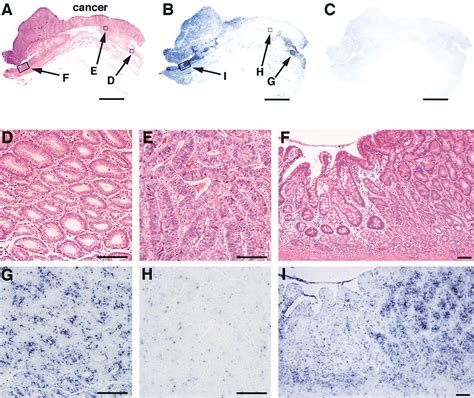 causal relationship between the loss of runx3 expression and gastric