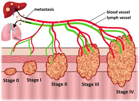 Rectal Cancer Home Remedies What Colon Cancer Stages