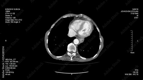 Ct Scan Computed Tomography Of Whole Abdomen With Contrast Computed