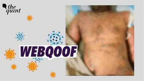 Fact Check Unrelated Images Shared As Human With Lumpy Skin Disease