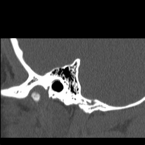 Normal Temporal Bone Ct With Annotated Images Radiopaedia 84293 99584 Lt Poschl Nc Commons