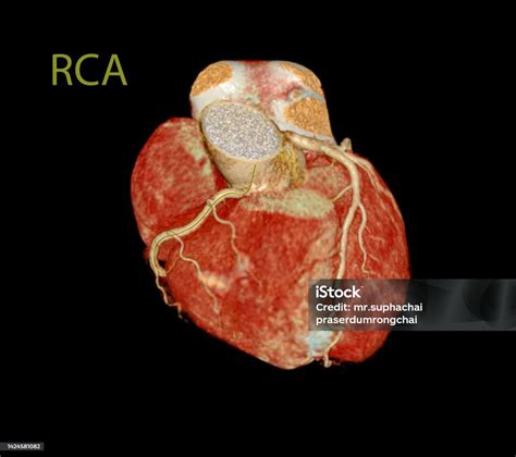 Ct 심장 3d 또는 Cta 관상 동맥 동맥 조영도에 대한 스톡 사진 및 기타 이미지 동맥 조영도 0명 Stenosis