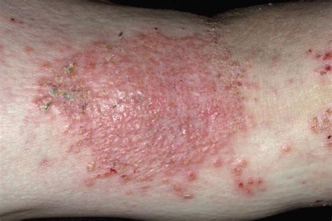 Eczema Clinical Tree