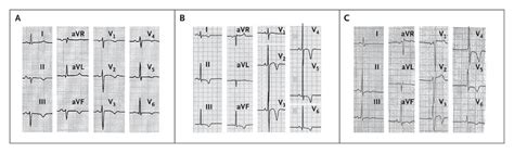 Repolarization Abnormality Ecg