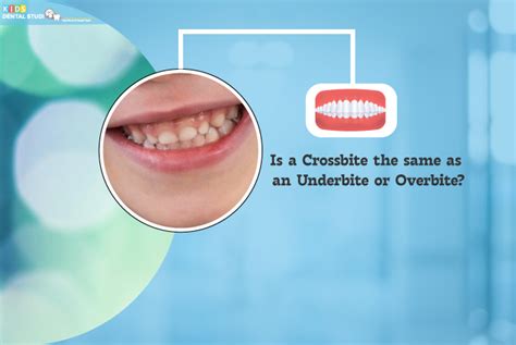 Dental Misalignments Understanding Crossbite Underbite And Overbite