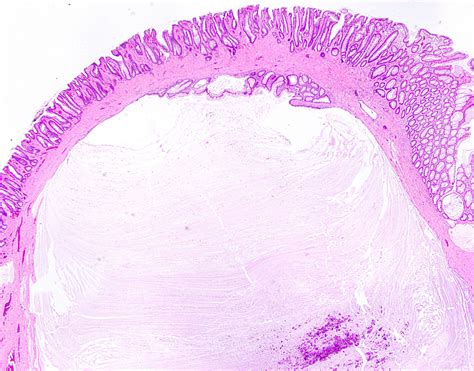 Ischemic Colitis Pathology Outlines At Spencer Maconochie Blog