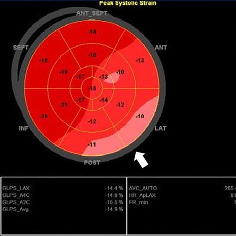 Spectral Doppler Imaging Of Hepatic Venous Flow By Echocardiography