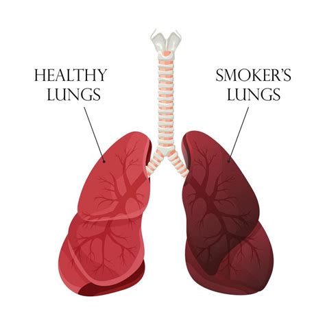 Illustration Of Normal Healthy Lungs And Lungs Smoker Concept Of Stop