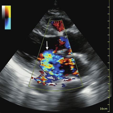A Transthoracic Echocardiogram Parasternal Long Axis View With Color