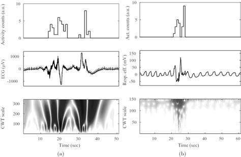 Example Of The Effect Of A Body Movement Artifact On A Ecg And B Download Scientific