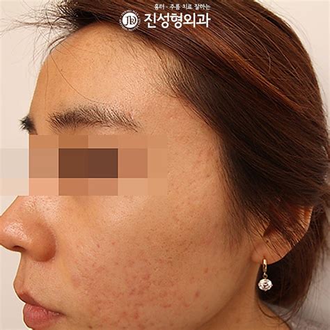 진성형외과 자가진피재생술 여드름흉터없애는 최후의 방법 10대부터 성인이 되기까지 여드름흉터제거