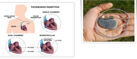 Pacemaker Rhythms Flashcards Quizlet