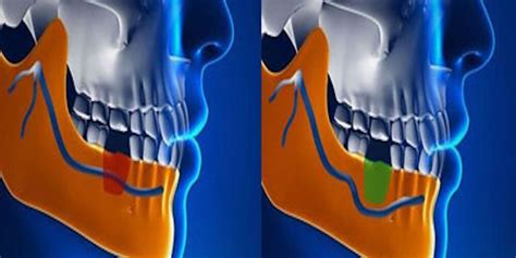 Nerve Repositioning Dentalimplantindia