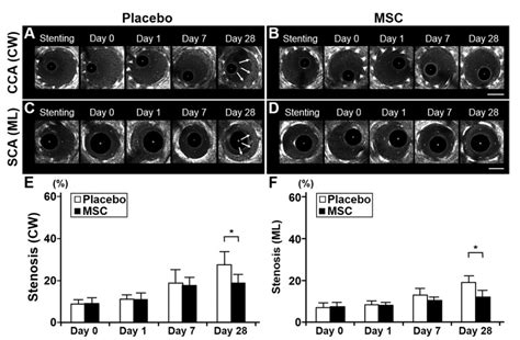 通过静脉注射间充质干细胞预防血管内支架引起的新生内膜增生 脑医汇