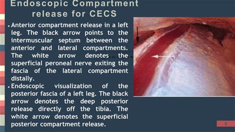 Chronic Exertional Compartment Syndrome Pptx