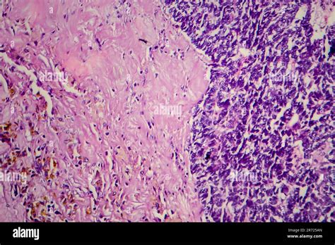 Wilms Tumor Or Nephroblastoma Light Micrograph Photo Under
