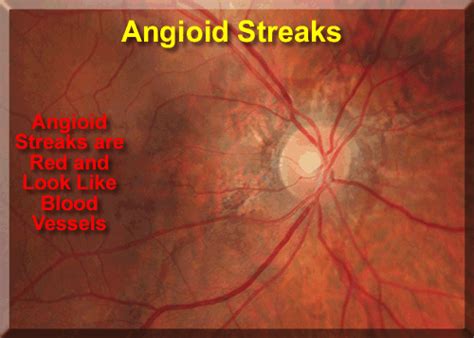 Differential Diagnosis Of Angioid Streak Medical Zone