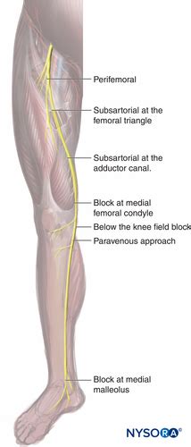 Ultrasound Guided Saphenous Adductor Canal Nerve Block Flashcards