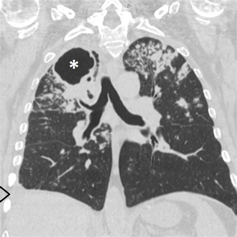 Ct Demonstrates Confluent Bronchocentric Nodules In All Segments With A