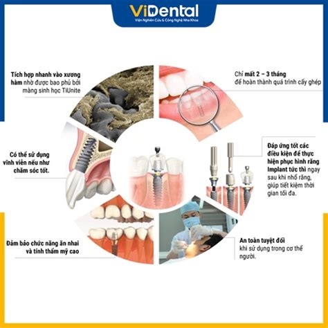 Trụ Implant Nobel Xuất Xứ Cấu Tạo Và Giá Cả Khi Lắp Trụ