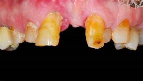 150 Resesi Gingiva Foto Stok Potret And Gambar Bebas Royalti Istock