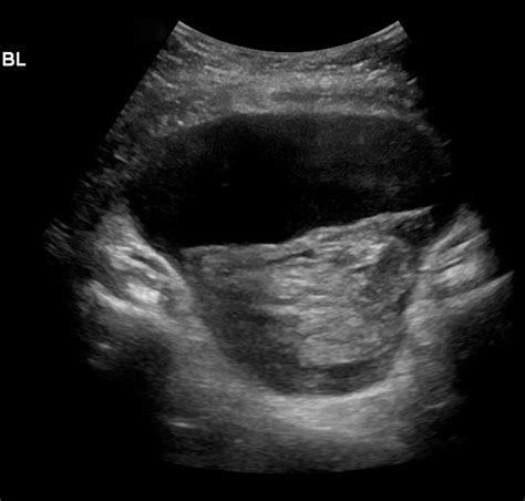 Pearls And Pitfalls In Diagnosing Pediatric Urinary Bladder Masses