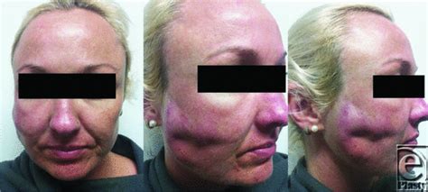 Collar Button Abscess