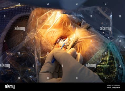 Diopter Lens Implant At Ruby Najar Blog