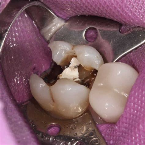 Safe Mercury Amalgam Removal Smiles With Aloha Kihei Dentist