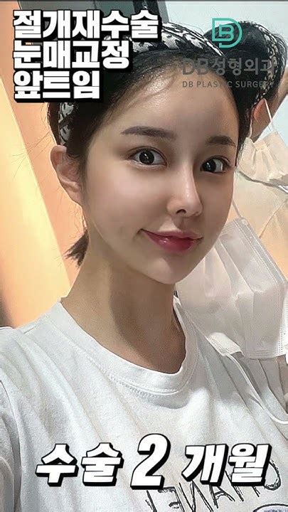 눈재수술 화려함 그 자체 세미아웃라인의 정석 Shorts Youtube