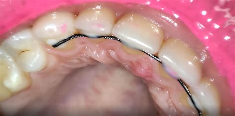 Princess Clip Store Permanent Retainers Mouth Tour