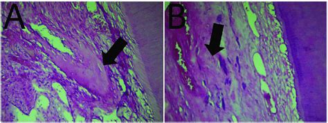 The Arrow Points To Pulp Calcifications A Photomicrograph Of Dental Download Scientific