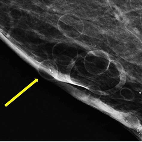 Zoomed In Craniocaudal Magnified View Of The Patients Right Breast On