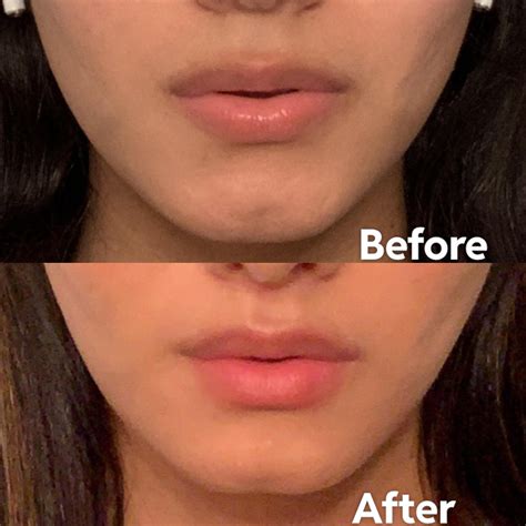 45 Months Post Op Lower Face Work Mandible Contouring W Sliding
