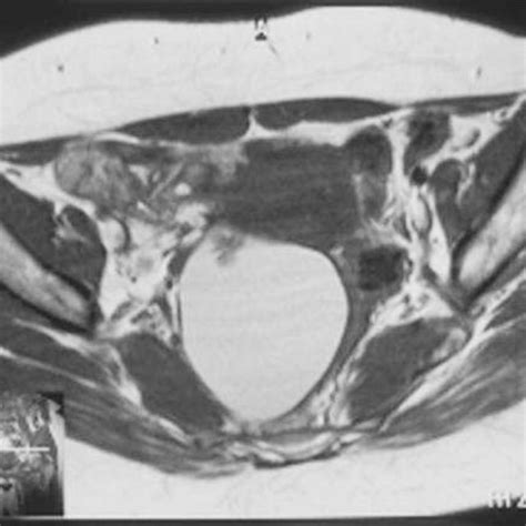 Magnetic Resonance Imaging With T2 Weighted Sequences In Sagittal View